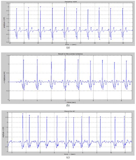 Feature Vector Selection For Automatic Classification Of Ecg Arrhythmias Open Access Journals