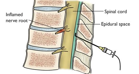 Sciatica Causes Treatment OrthoInfo AAOS