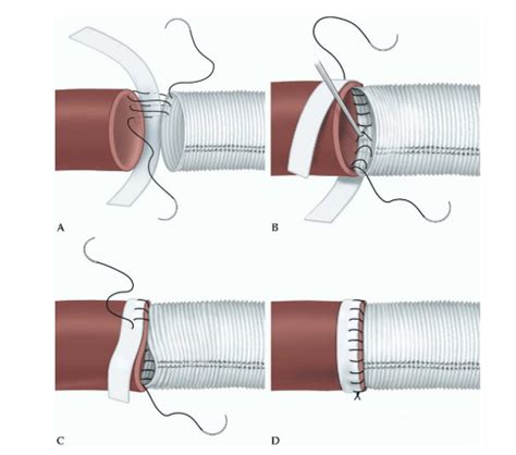 主动脉手术中特氟龙毛毡支撑缝合线的长期完整性患者进行病例