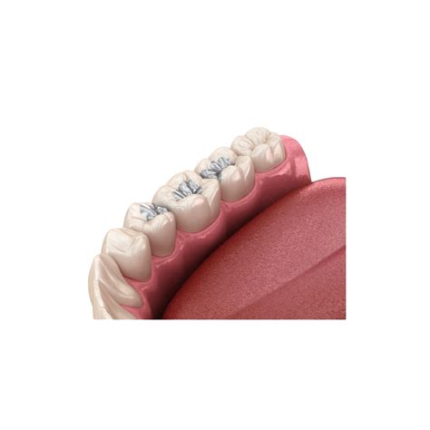 Fissure Sealant In Perth Mindarie Quinns Dental