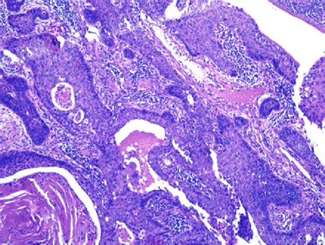 Lymph Node Metastasis By Squamous Cell Carcinoma Hande Stain X100