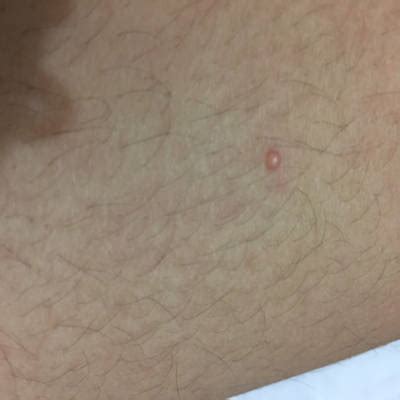 身上起小水泡不痒 身上起小水泡痒是艾滋 随意云