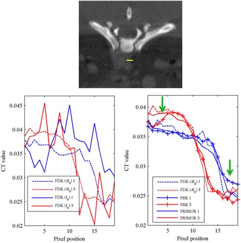 Respiratory Motion Correction Normalized Profile Along The Yellow Line
