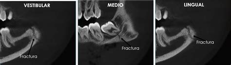 Fractura Mandibular Múltiple Dento Metric Radiología Dental Oral Y