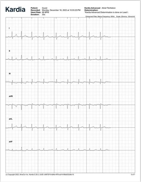 Wenckebach R Readmyecg