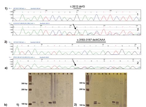 A Specific Mutations In The Apc Gene Of Fap A Sequencing Shows The