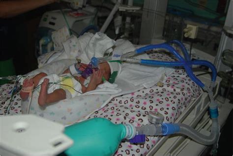 Of The Neonate With A Difficult Critical Airway Ento Key