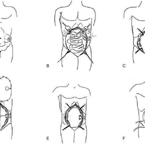 Fundamentals Of Laparoscopic And Open Repair Of Subxiphoid Hernia After Download Table