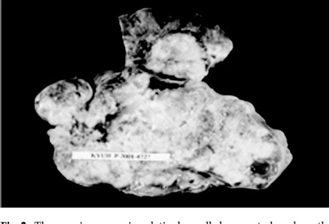 Figure 2 From A Case Of Peripheral Primitive Neuroectodermal Tumor Of The Ovary Semantic Scholar