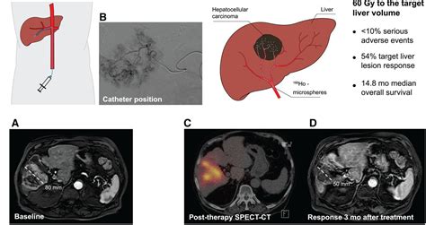 Safety And Efficacy Of 166ho Radioembolization In Hepatocellular Carcinoma The Hepar Primary