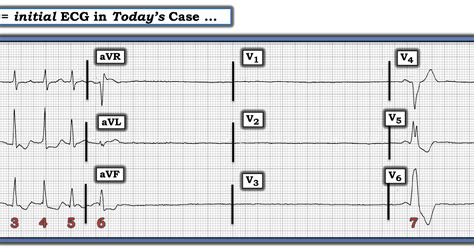 Ecg Interpretation Ecg Blog 342 This Is A 12 Lead Ecg