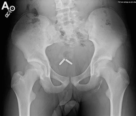 Ischial Apophysis Avulsion Fracture Sports Medicine Review