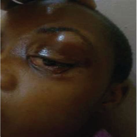 Image Of The Teenagers Face Showing The Orbital Abscess On The Seventh Download Scientific