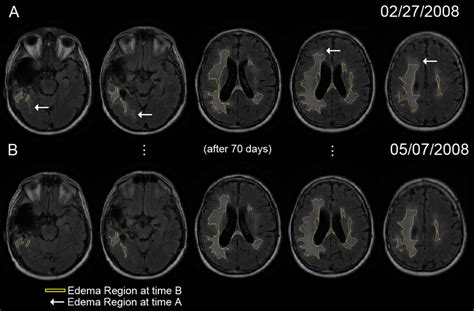 Qualitative Spatiotemporal Segmentation Results Using T Mcmnb A