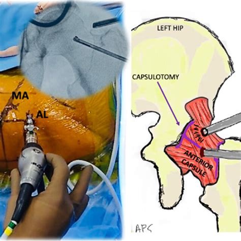 A Hip Capsulotomy Performed In This Adolescent Patient A Small T