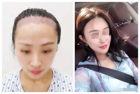 女生植发是一种什样的体验 知乎