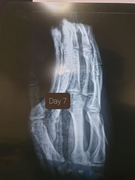 Metacarpal Shaft Fracture R Brokenbones