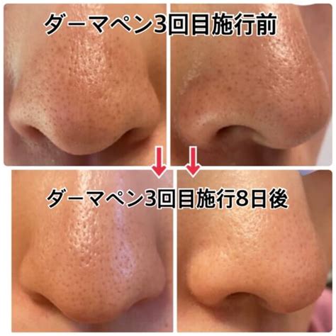 【検証】ダーマペン3回目で鼻の毛穴は改善する？ダウンタイムの様子や比較写真も リリログ