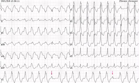 Twelve Lead Ecg Showing A Wide Qrs Complex Tachycardia And Two Download Scientific Diagram