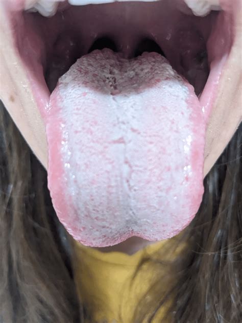 Doctor Claims This Cant Be Thrush Bc I Havent Had Sex Looks Like