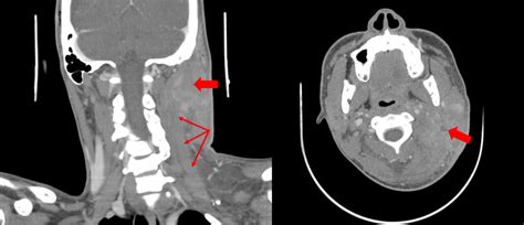 Ct Head And Neck Demonstrating Enhancing Soft Tissue Phlegmon With