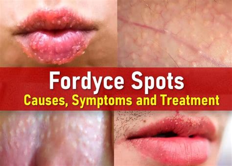 Fordyce Spots Causes Symptoms And Treatment