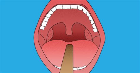 Tonsillectomy And Adenoidectomy