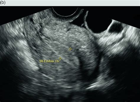 Retroverted Uterus Transabdominal Ultrasound Retroverted Retroflexed