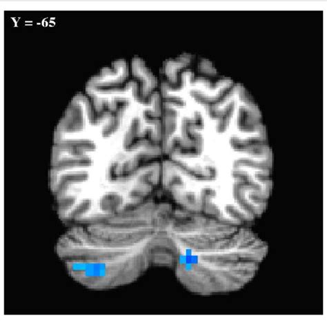 Cerebellar Clusters Exhibiting A Diagnosis By Sex Interaction Shown Download Scientific
