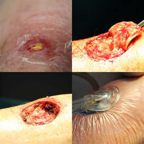 Posttraumatic Panniculitis Case Series And Literature Review