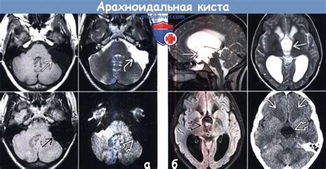 Диагностика арахноидальной кисты по КТ МРТ УЗИ