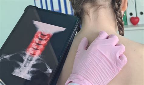 Аномалия Киммерли симптомы лечение причины диагностика виды