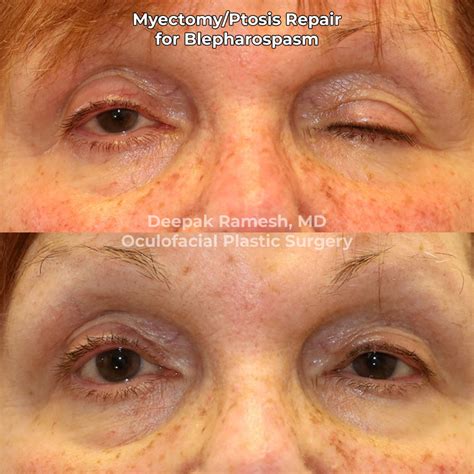 Blepharospasm Botox Before And After
