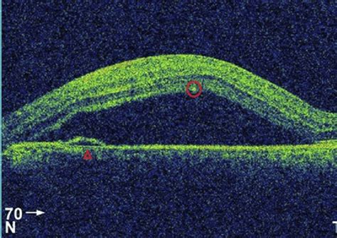 OCT Showing Hyper Reflective Deposits In The Intra Retinal Layer Download Scientific Diagram