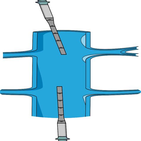 Venous Arterial Femoral Cannula Ecmo Figure Science Figures