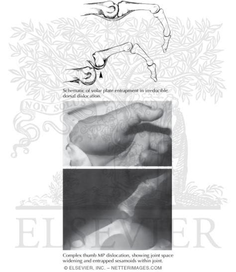 Metacarpophalangeal Mp Dislocation