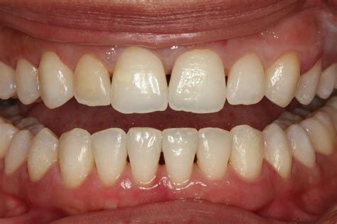 Bioclear Veneers Before And After At Jeffery Knight Blog