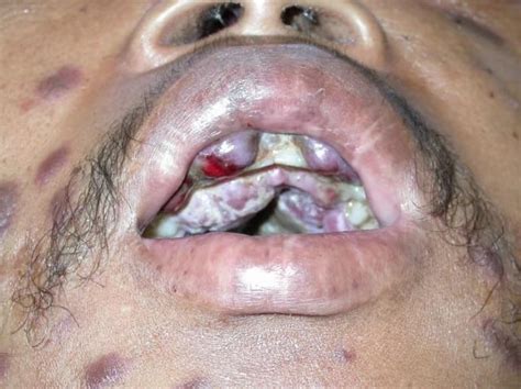 Kaposi Sarcoma Face The Prognostic Significance Of Facial Lymphoedema