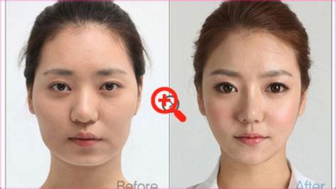 Surgery To Make Eyes Bigger Before And After Rosesandmakeupp