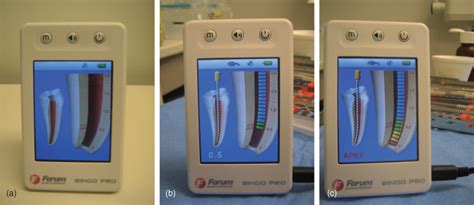 14 Electronic Apex Locators And Conventional Radiograph In Working Length Measurement Pocket
