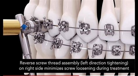 Powerscope™ Class Ii American Orthodontics Macedonia