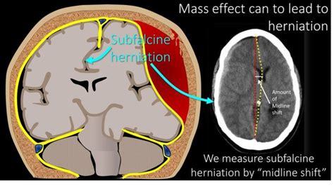 Mass Effect Midline Shift And Herniation —simply Explained