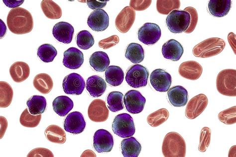 Acute Lymphoblastic Leukemia Bone Marrow Smear Stock Illustration