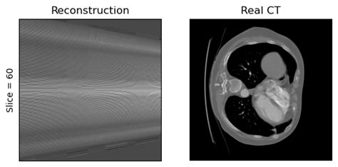 3D Reconstruction Diffdrr