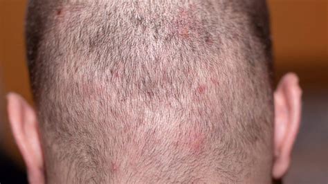 Folliculitis Remedy Tricholab