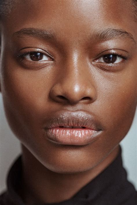 Seborrheic Dermatitis Face African American