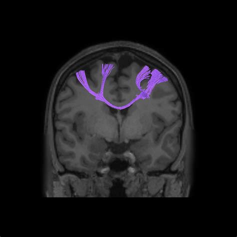 Dorsal Attention Network Connectome Guide