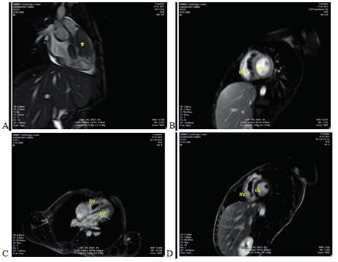 Cardiac Mri A Mri Cine Ssfp Sequence Two Right Chamber View Download Scientific Diagram