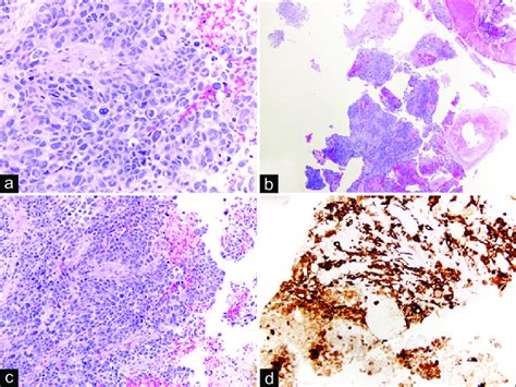 Histopathology Of Grade Iv Glioblastoma Multiforme Tumor A C