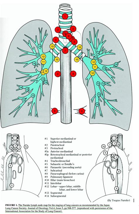 Tcancer Lymph Node Mapping The Role Of Lateral Neck Ultrasound In